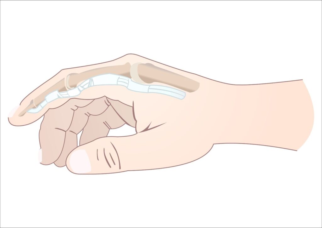 The Best Trigger Finger Exercises: Relief Techniques for Stiff Fingers ...